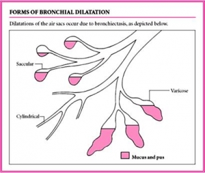 Forms of bronchial dilatation - Bronchiectasis