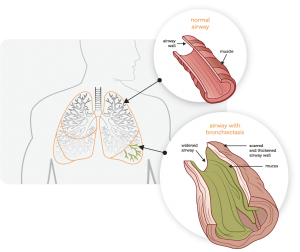 Pathophysiology - Bronchiectasis