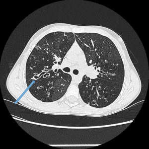 Radiology - Bronchiectasis