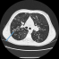 Radiology - Bronchiectasis