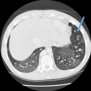 Radiology - Bronchiectasis