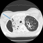 Radiology - Bronchiectasis