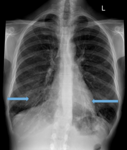 Radiology - Bronchiectasis