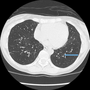 Radiology - Bronchiectasis