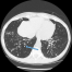 Radiology - Bronchiectasis