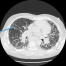 Radiology - Bronchiectasis
