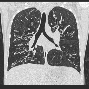 Radiology - Bronchiectasis
